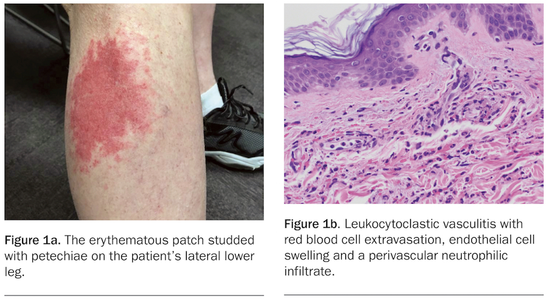 Exercise Induced Capillaritis
